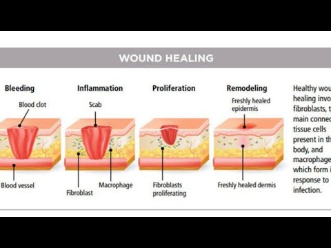 Local and Systemic Factors that Influence Wound Healing - YouTube