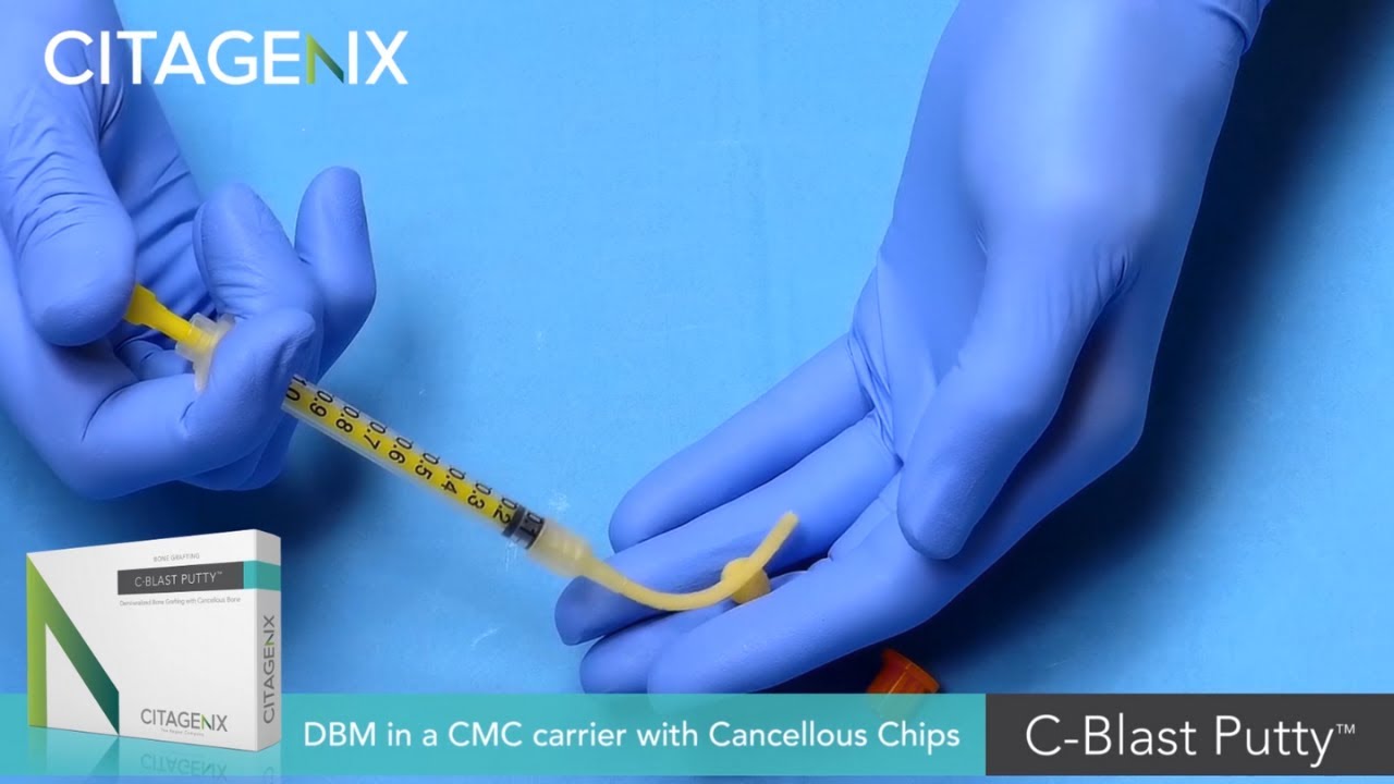Bone Graft - DBM with Cancellous Chips in a CMC carrier [C-Blast Putty ...