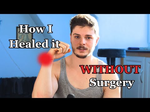TFCC Tear Destroyed My Wrist – Then I Did This