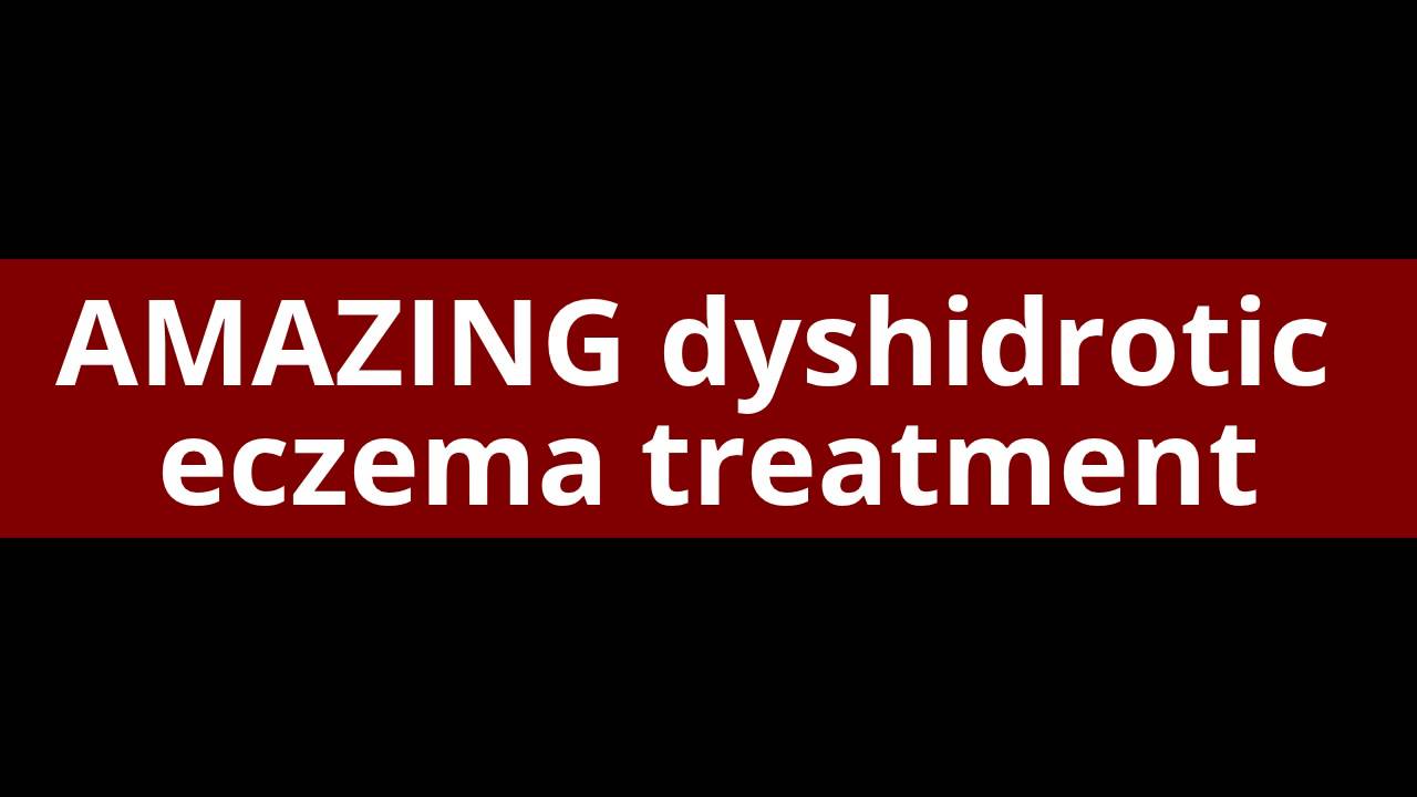 Amazing Dyshidrotic Eczema Treatment Youtube