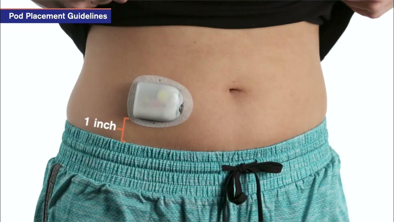 Insulin Pump Training Omnipod Dash® How To Select A Pod Placement