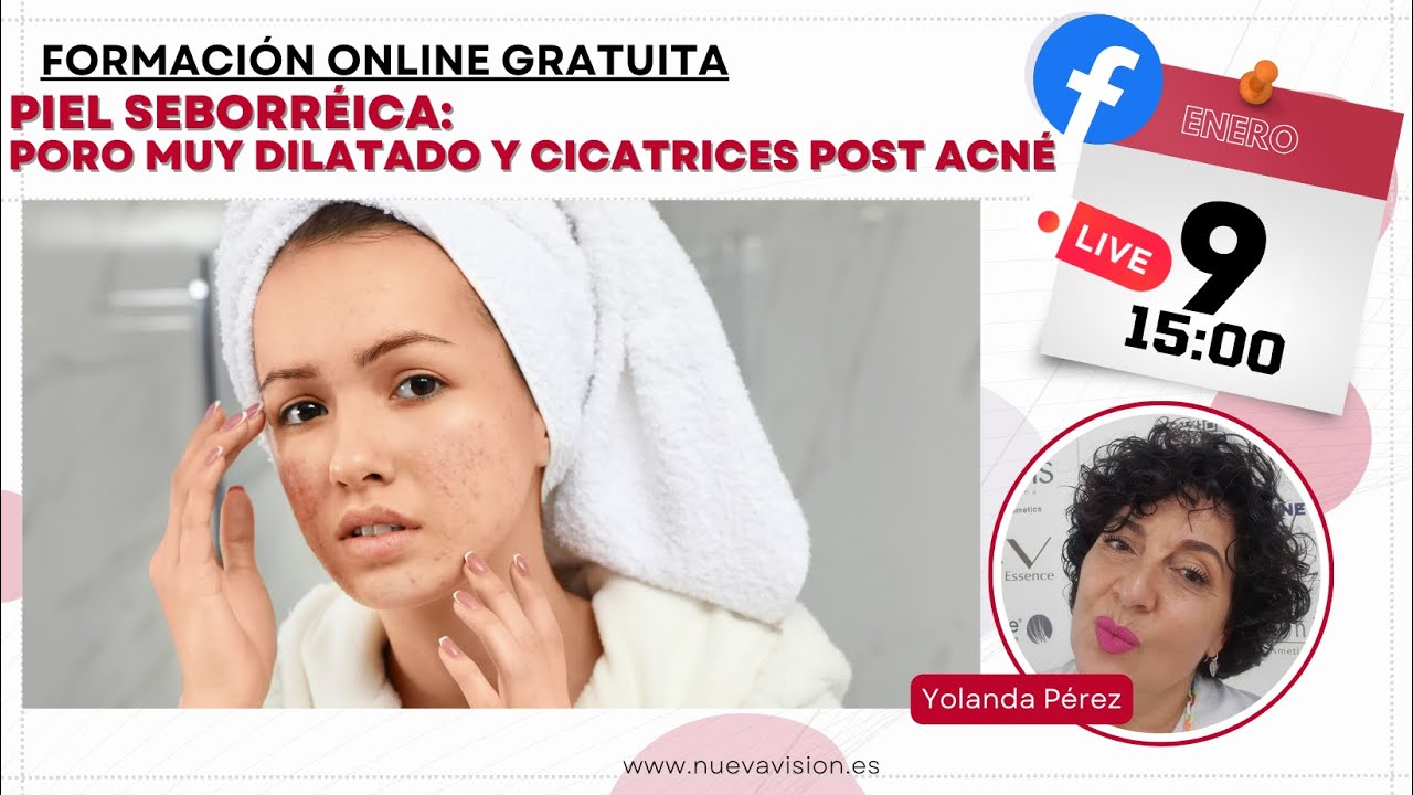 Piel seborreica, poro muy dilatado y cicatrices post acne - YouTube
