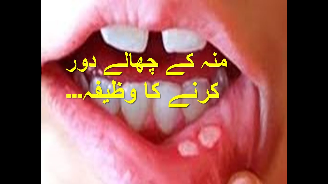 mu ke chalo kawazifa | muh k chale ka ilaj | منہ کے چھالے دور کرنے کا ...