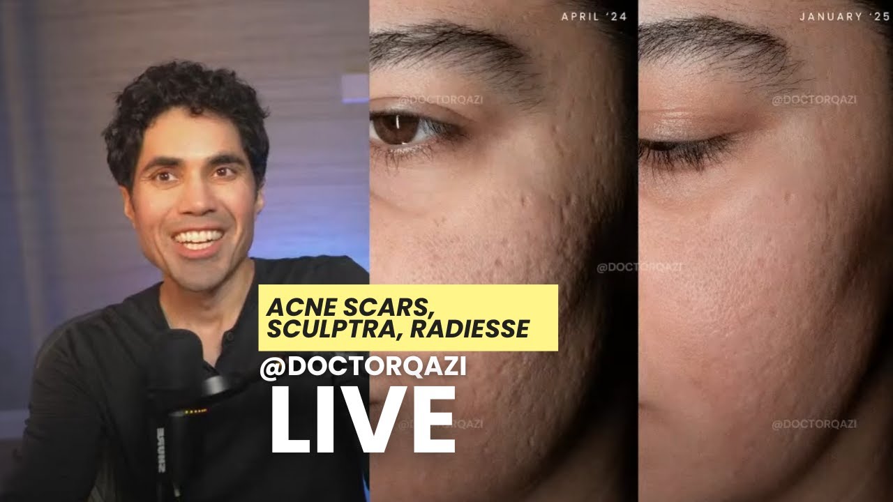 Dr. Qazi discusses Acne Scars, Sculptra, Radiesse, Bellafill | Dr. Qazi ...