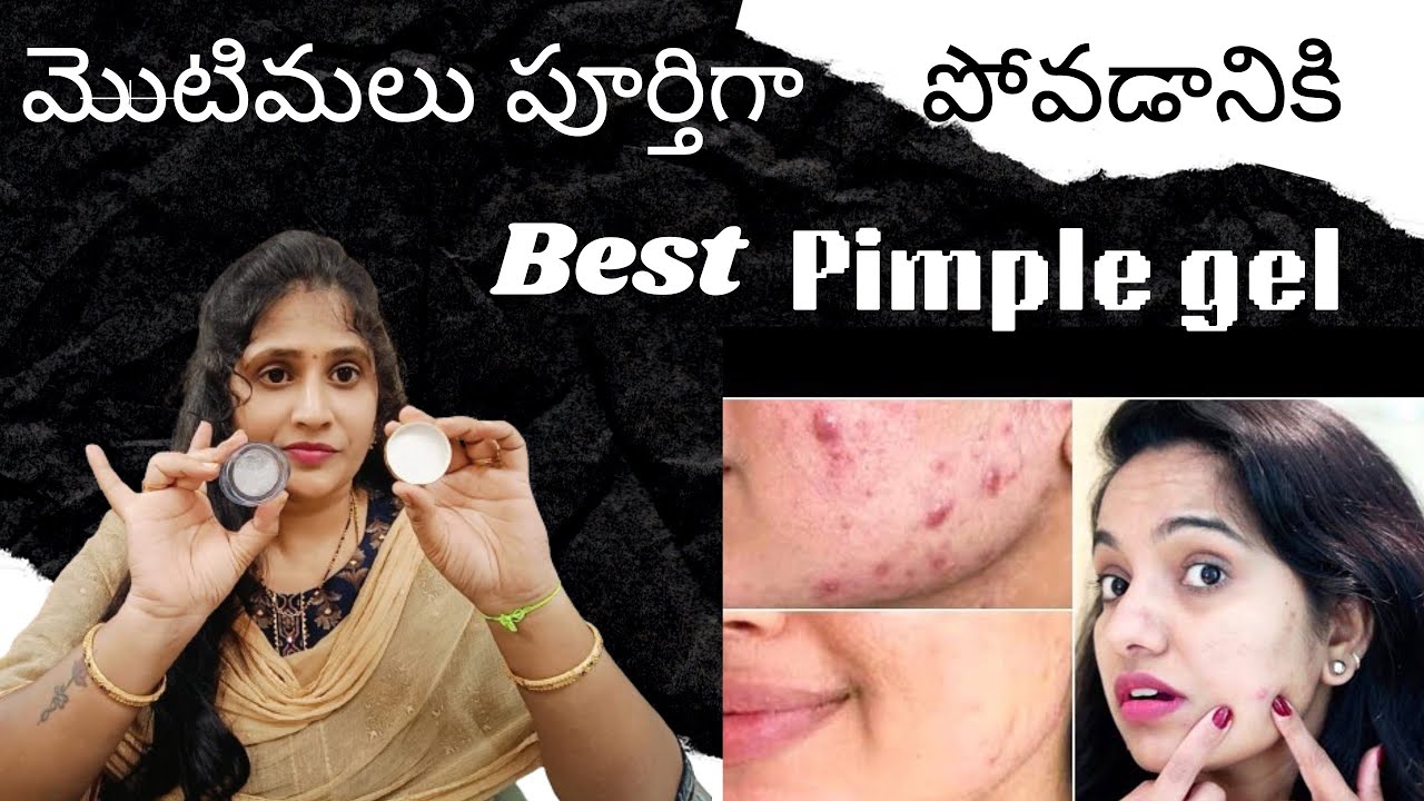 Best cream for pimples without side effects/ how to get remove pimple ...