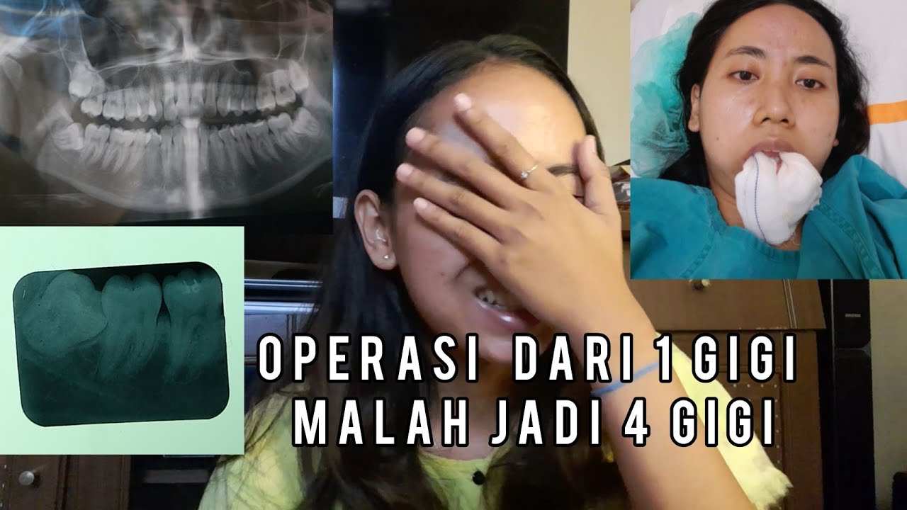 Akhirnya Operasi Impaksi Gigi Bungsu #2 - YouTube