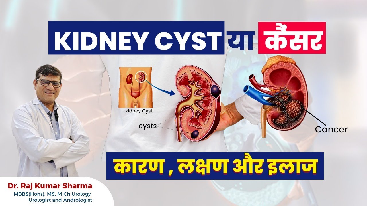 Kidney Cyst or Cancer Relationship| Cyst Type |Treatment | Dr. Raj ...