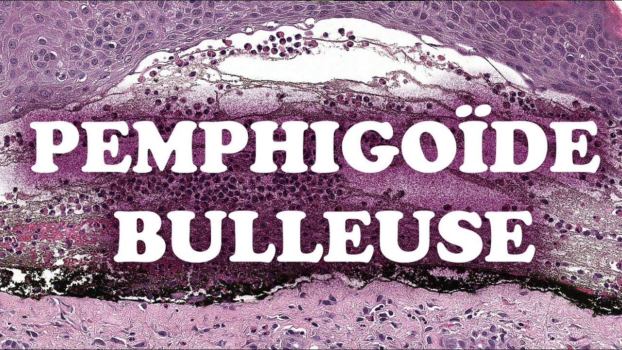 LA PEMPHIGOÏDE BULLEUSE - PATHOLOGIE - YouTube