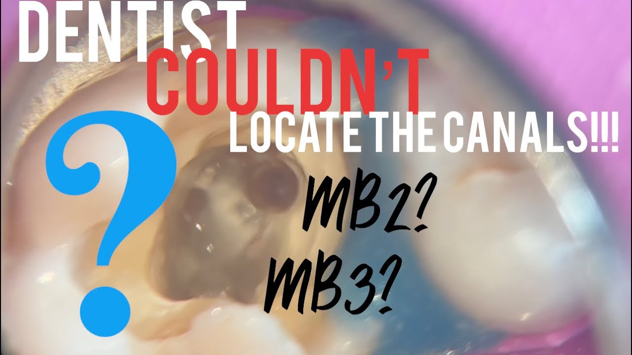 🟡UL6 RCT. 🔴Referring Dentist COULDN’T Find All The Canals! MB2 and MB3 ...