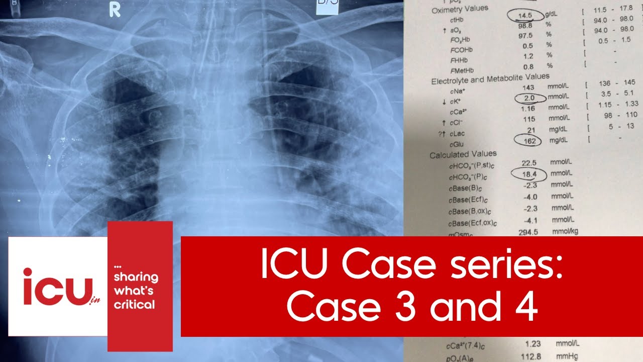 #icucase 3 & 4: ( misplaced line - where??) & (neuro + metabolic) - YouTube