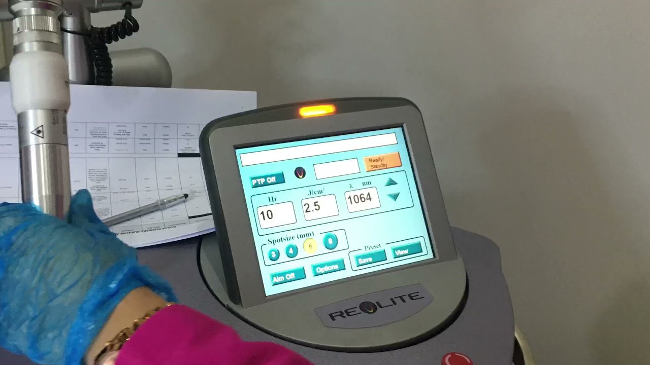 Revlite treatment for Melasma - YouTube