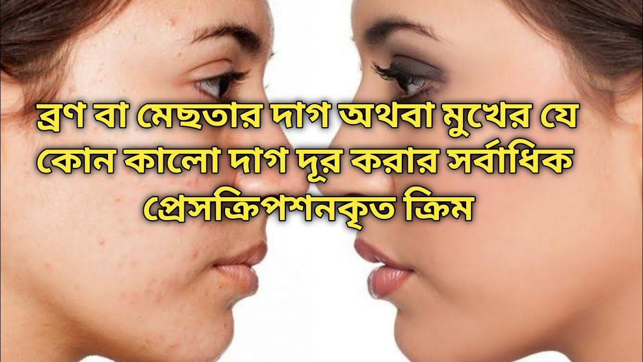 Mukher Kalo Dag Dur Korar Cream।Broner Dag Dur Korar Cream।Pora Dag Dur ...