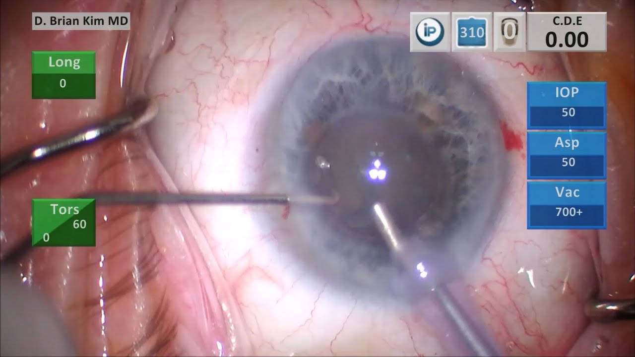 How Good Is Your Cataract Technique? True Test: Small Pupil, Corneal ...