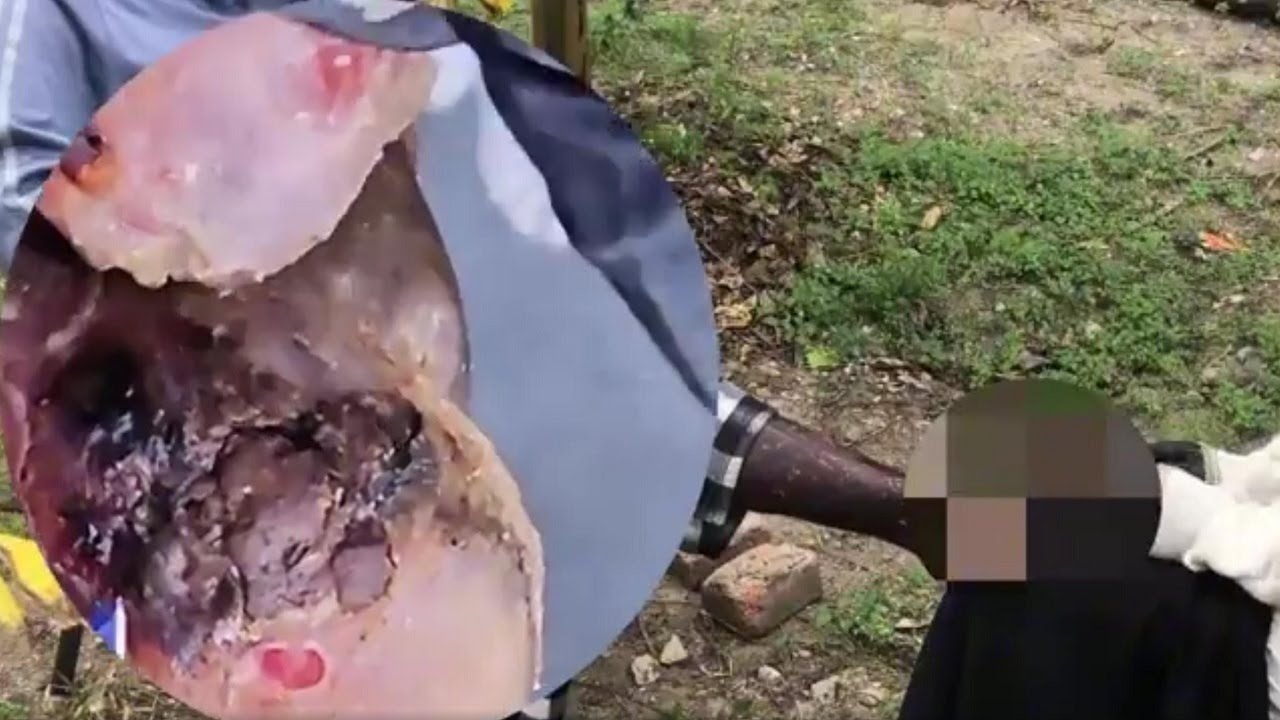 🤯 Horrific Jigger Infection – Rotten Heel Peeled Away! 315701 - YouTube