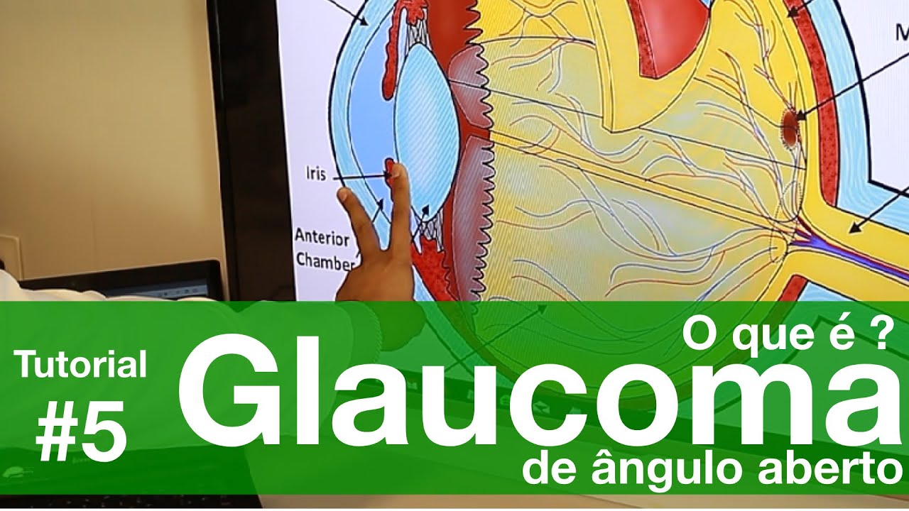 Tutorial Glaucoma #5 Glaucoma de Ângulo Aberto | Tutorial # 5 Open ...