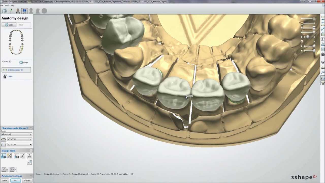 Dental System™ 2012 - Smile Composer™ - YouTube
