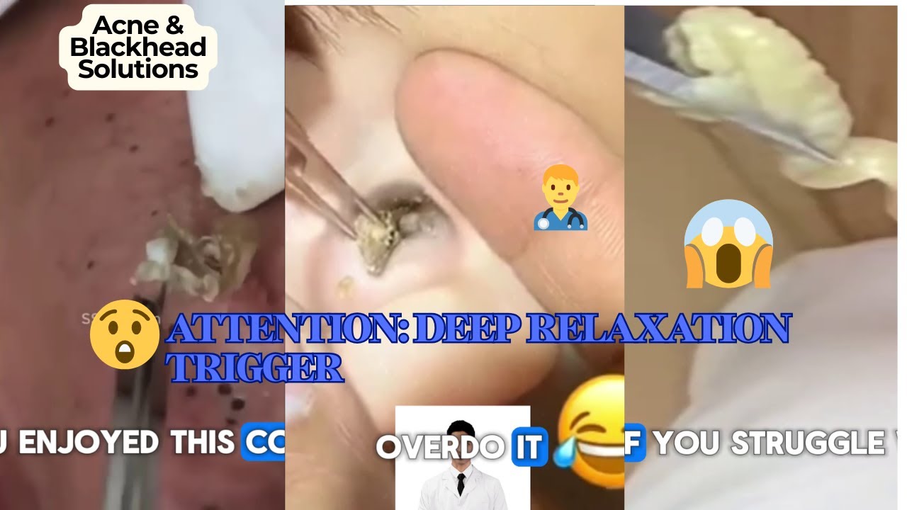 Most Satisfying Pimple Popping, Cyst Removal, Acne & Blackhead ...