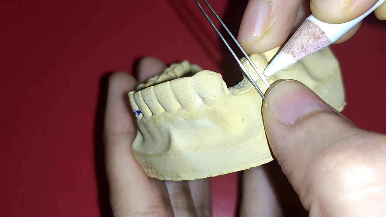 Helical canine retractor, ORTHO GDC NAGPUR - YouTube