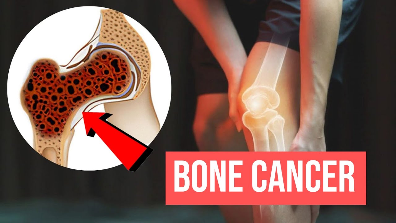 Bone Cancer Explained: Symptoms, Causes, Stages, and Treatment - YouTube