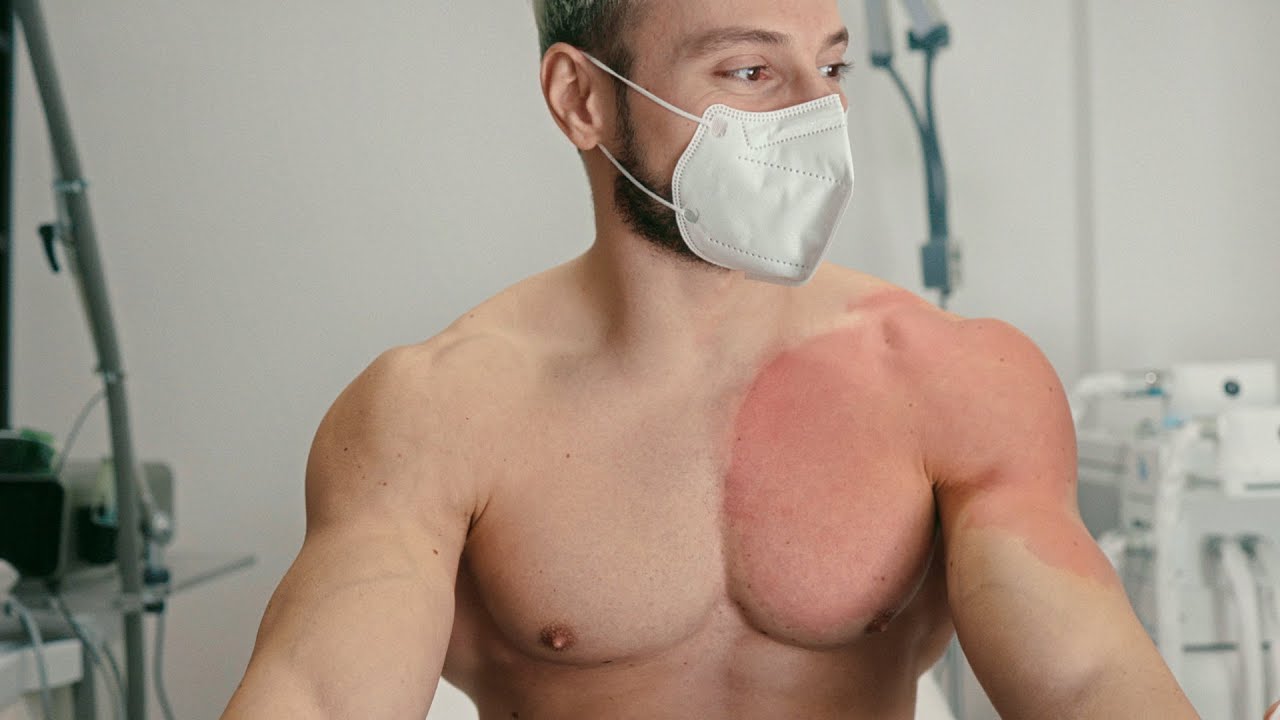 So...I had a Pec Tear - YouTube