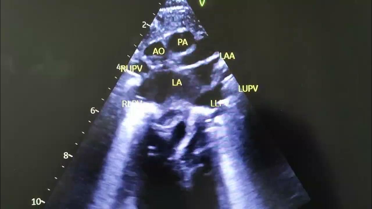 Suprasternal notch View -CRAB -VIEW ( demonstrating 4 Pulmonary vein into LA) - YouTube
