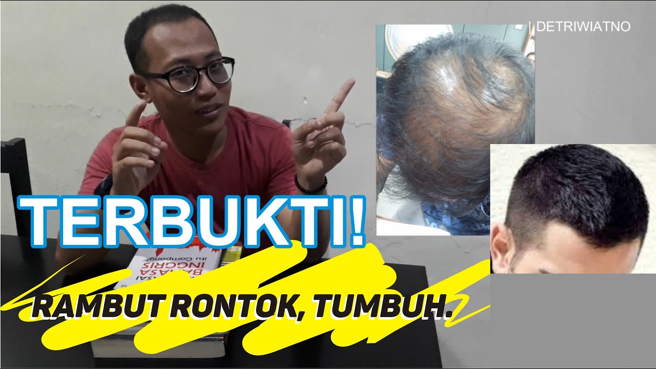 SUKSES MENUMBUHKAN RAMBUT BOTAK | HOW TO GROWING UP THE HAIR LOSS (For ...