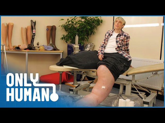 Proteus Syndrome Mandy Sellars 7069