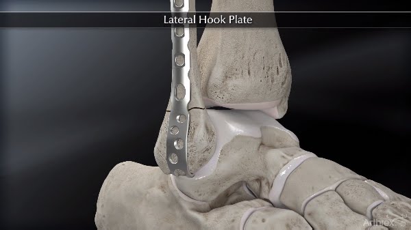 Lateral Hook Plate - YouTube
