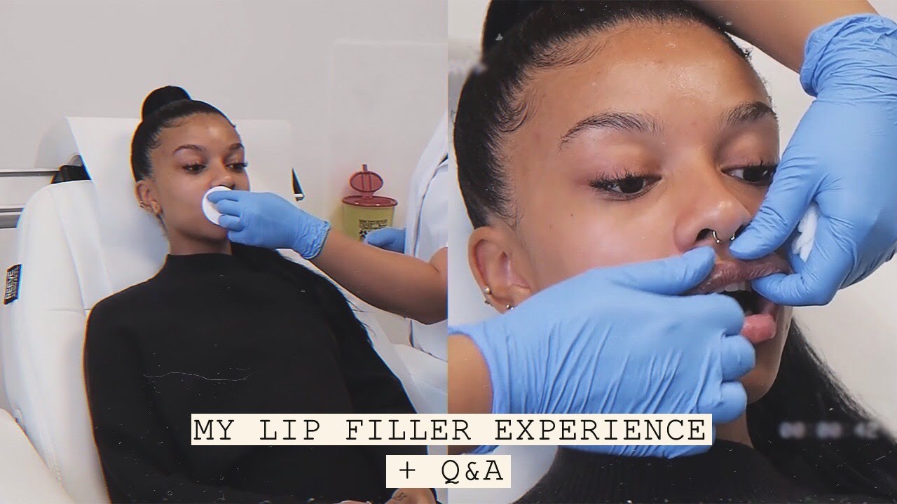 my lip filler experience + q&a. - YouTube