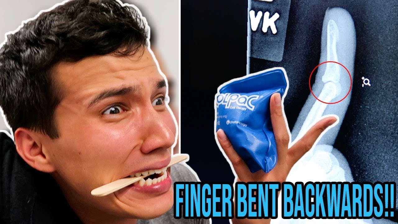 BROKE MY FINGER!! - YouTube