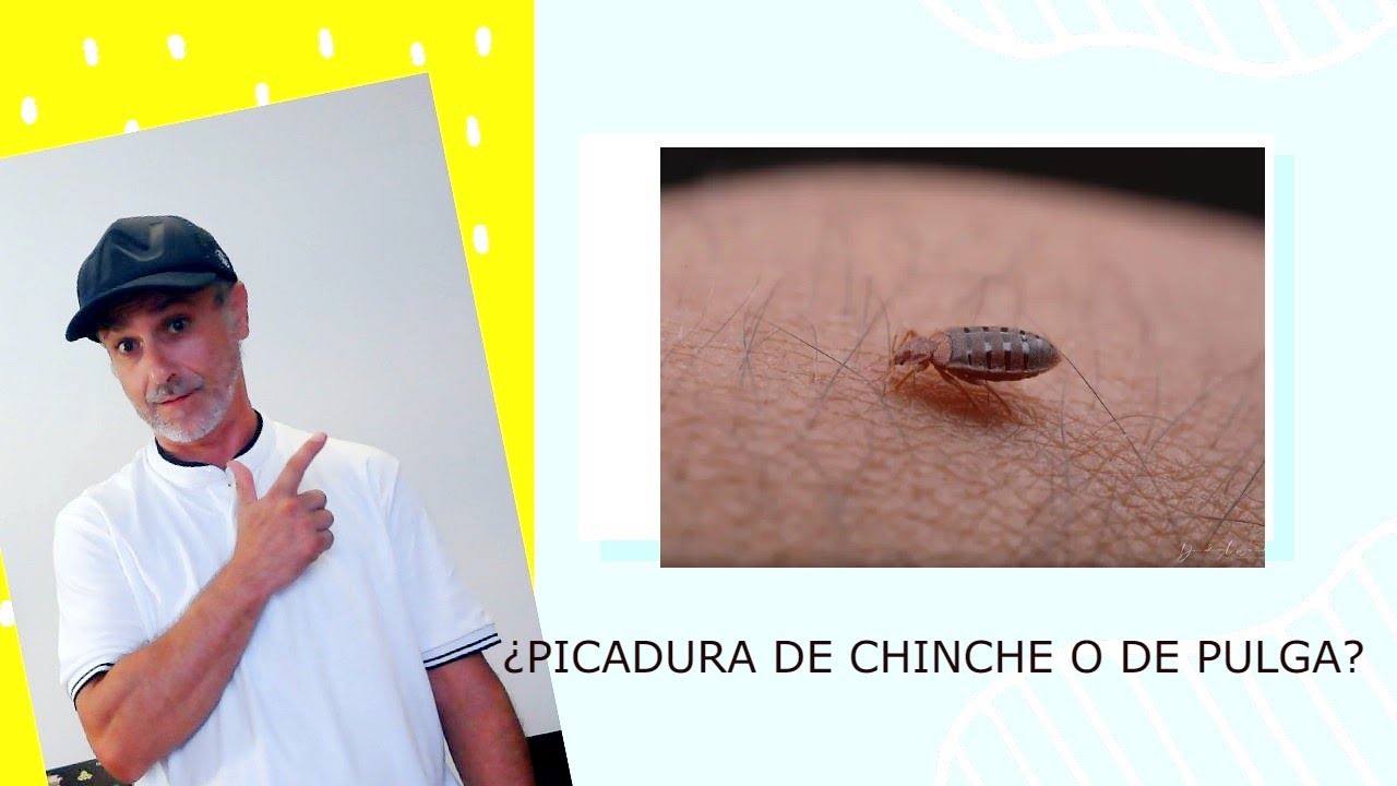 👁DISTINGUE FACILMENTE la picadura de CHINCHE de la de PULGA - YouTube