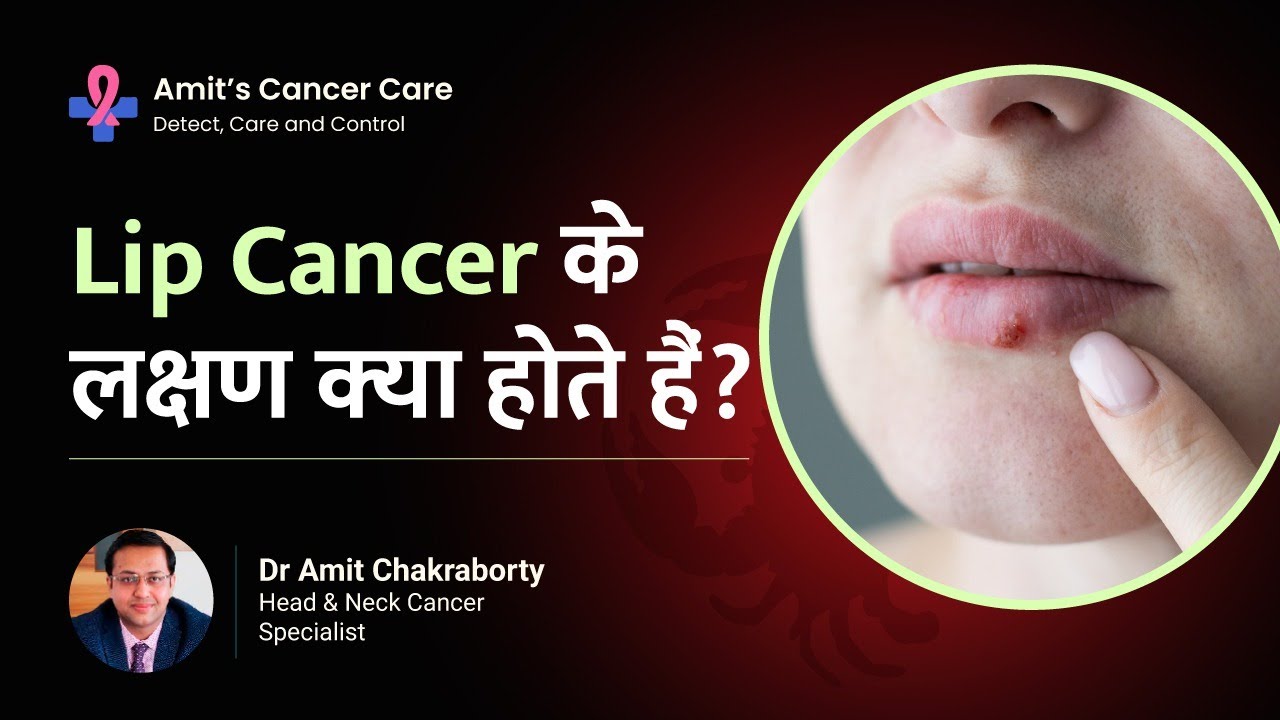 Don't Ignore These Lip Cancer Symptoms! | Lip Cancer के लक्षण | Dr Amit ...