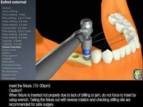 MegaGen - 3D ExFeel External - YouTube