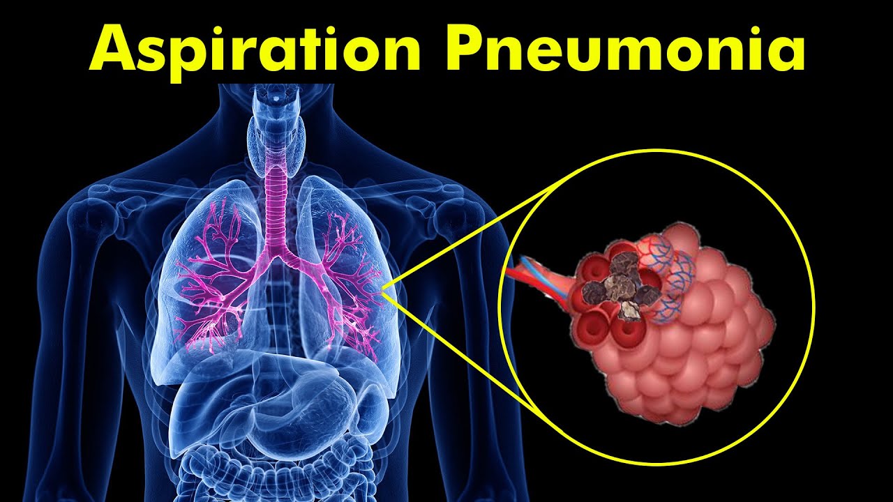 Breathing Trouble: Understanding Aspiration Pneumonia - YouTube