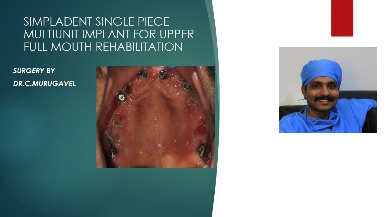Simpladent single piece multi unit for upper full mouth rehabilitation ...