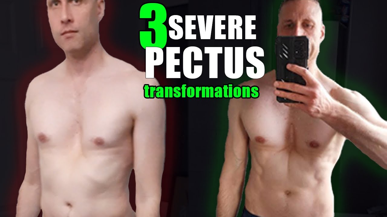 3 SEVERE SUNKEN CHEST TRANSFORMATIONS with Exercise Only (NO SURGERY ...