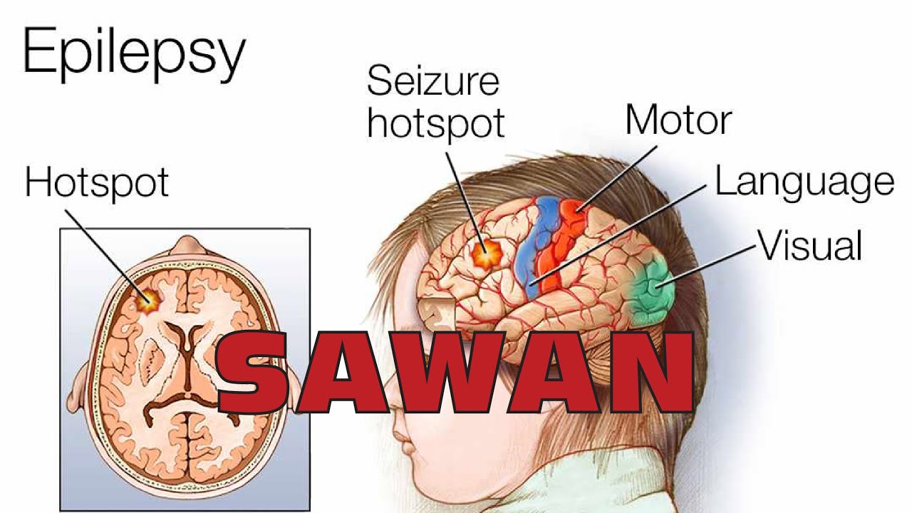 SAWAN/EPILEPSI, Apa yang perlu anda tahu! | Dr. Noordin Darus - YouTube