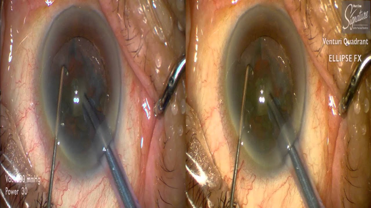 3D Cataract surgery with Venturi mode 'Signature ( AMO )' - YouTube