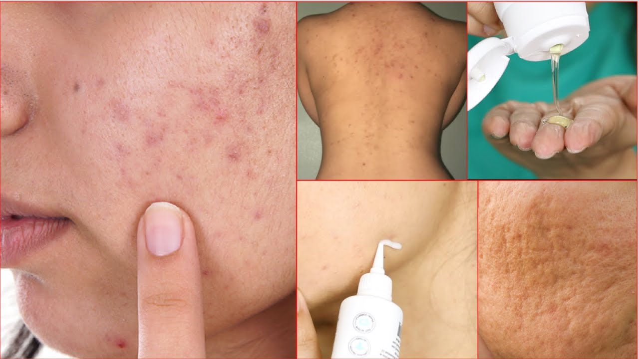 ACNE-PRONE SKIN CARE ROUTINE - How to treat Active Acne & Acne spots ...