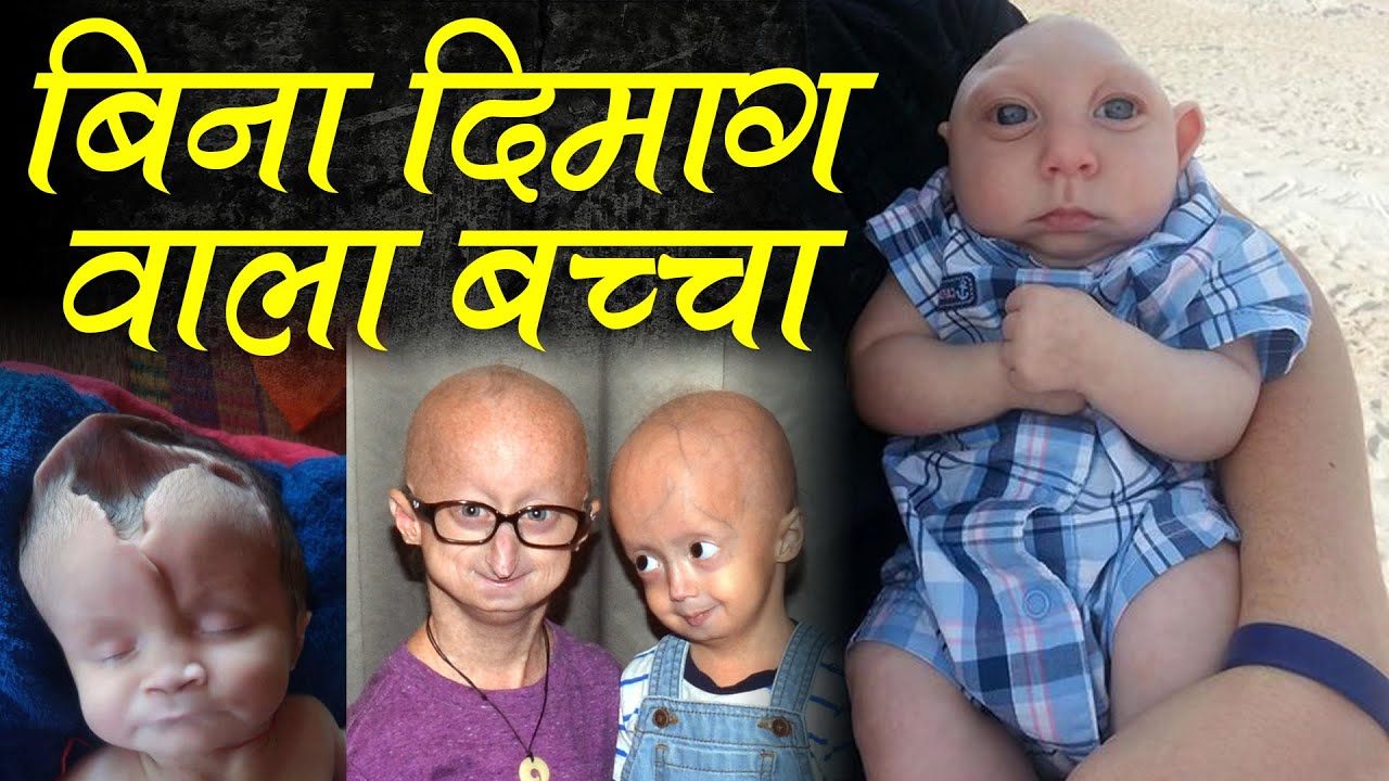 Rarest Child || The children living with the world's rarest diseases ...