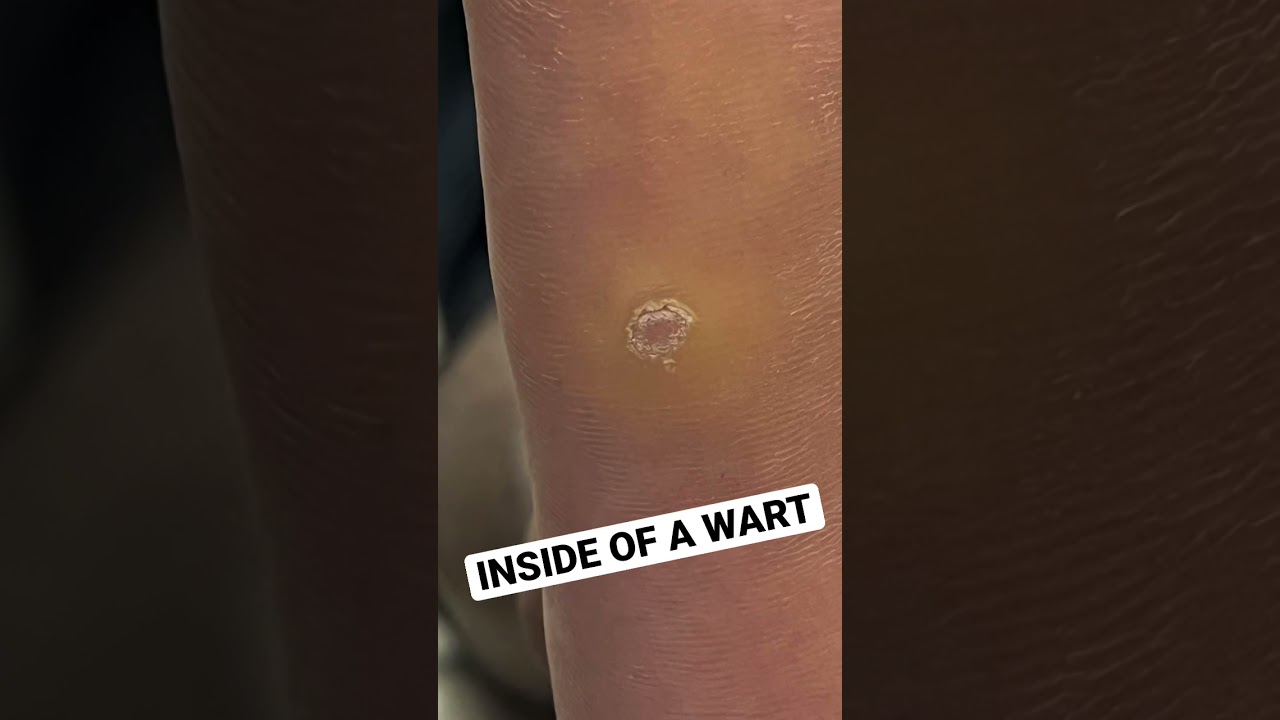 INSIDE OF A WART!! #shorts #plantarwart - YouTube