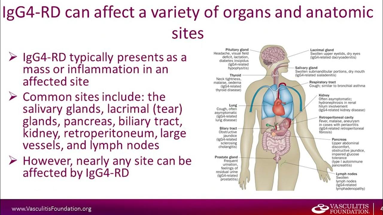 IgG4 Related Disease - YouTube