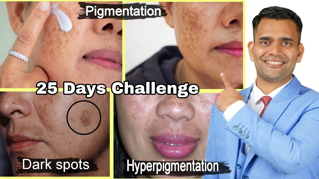 25 Days Challenge Get Rid Of Pigmentation, melasma Naturally - YouTube