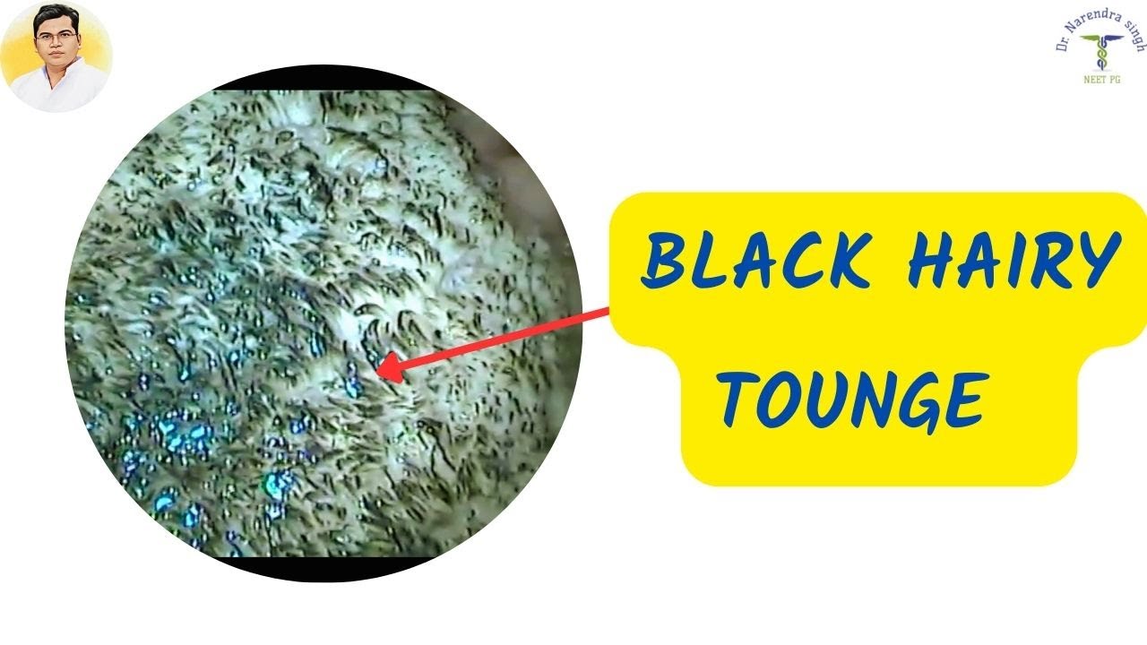 BLACK HAIRY TOUNGE WITH WHITE PATCH OVER UVULA - YouTube