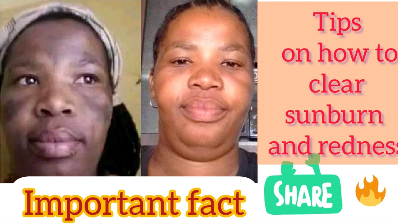 TIPS ON HOW TO GET RID OF SUNBURN AND REDNESS FAST - YouTube