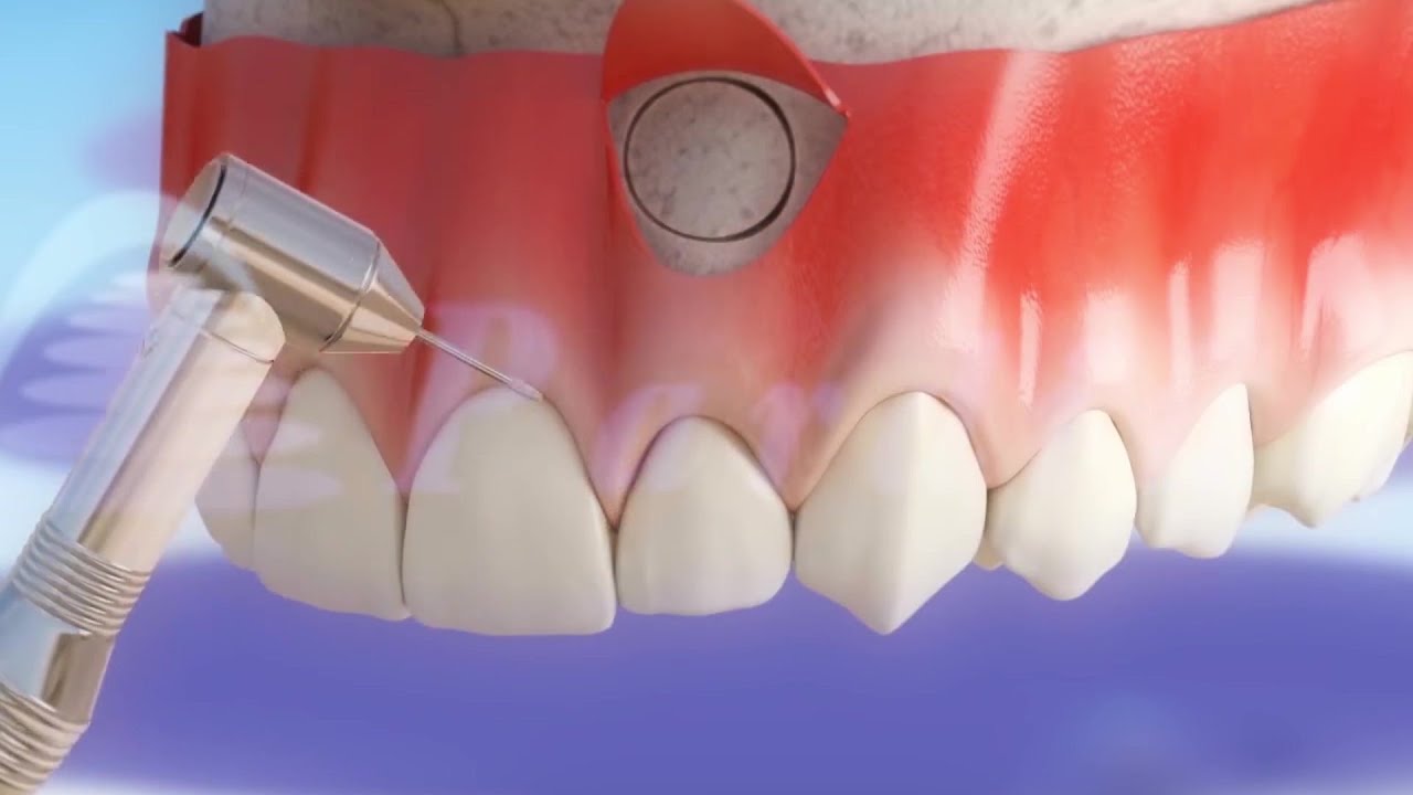 Apikal Rezeksiyon Operasyonu - YouTube