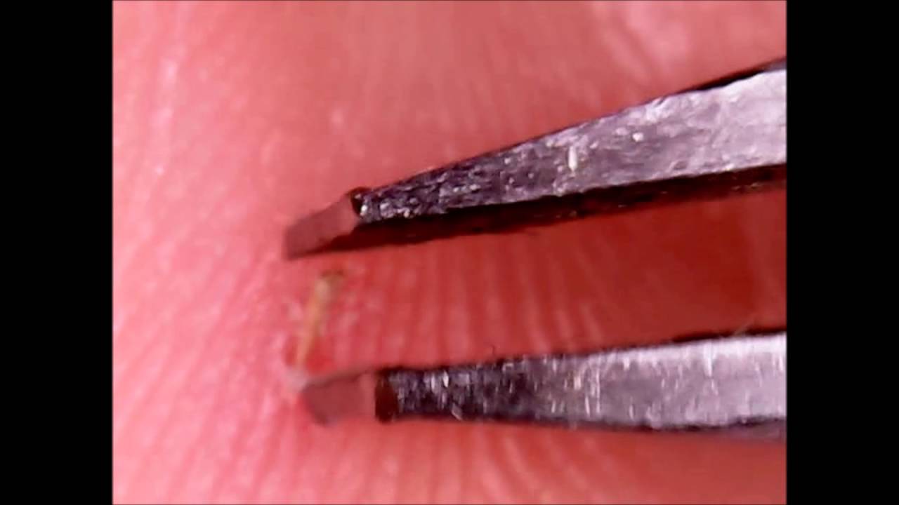 Splinter extraction under magnification - YouTube