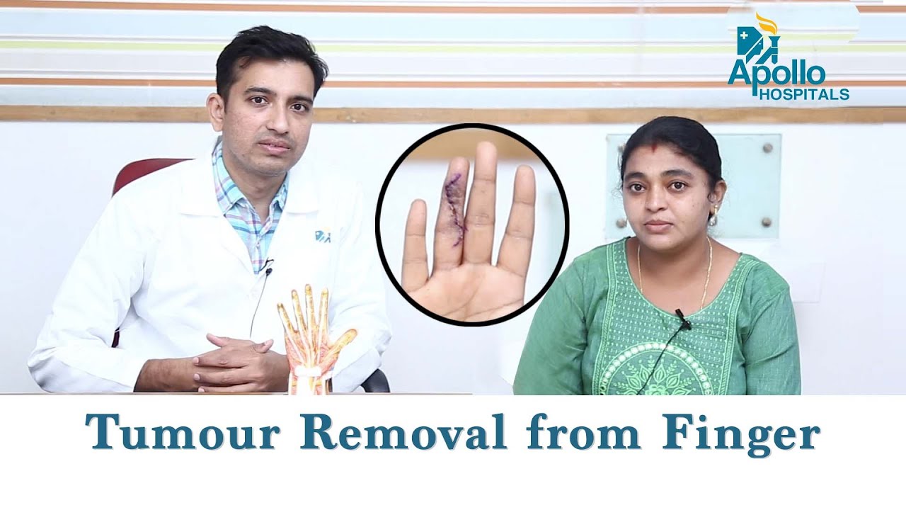 Tumour Removal from Finger | Patient Testimonial | Dr. Gopinath Bandari ...