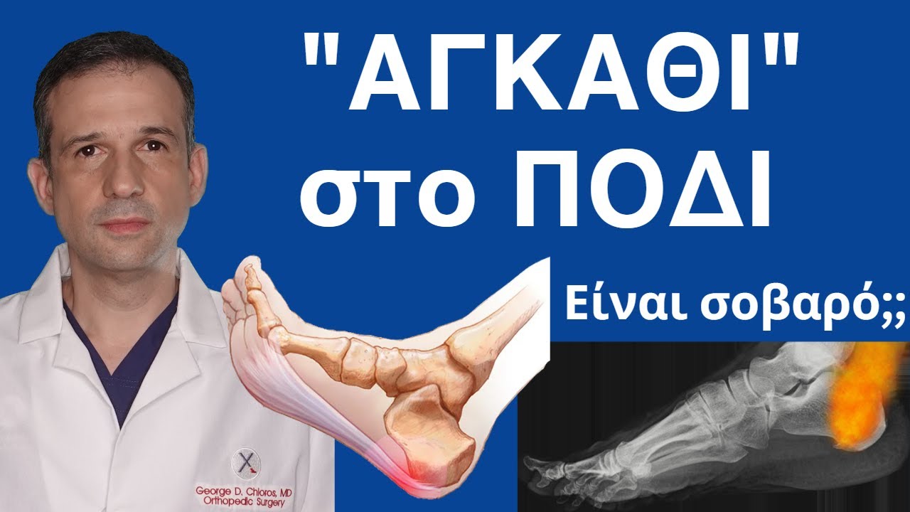 ΑΚΑΝΘΑ ("ΑΓΚΑΘΙ") ΣΤΟ ΠΟΔΙ ! ΜΥΘΟΣ ή ΑΛΗΘΕΙΑ; #orthopaidikos - YouTube