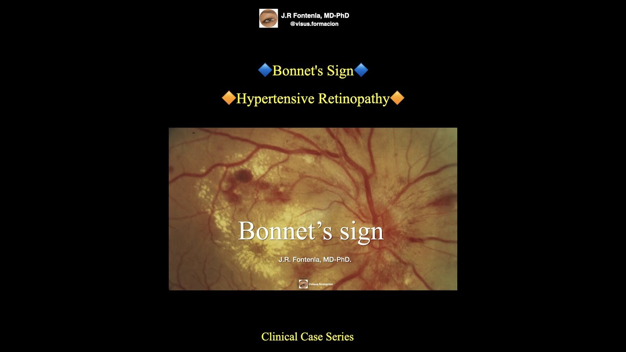 Bonnet's Sign. Hypertensive Retinopathy. - YouTube